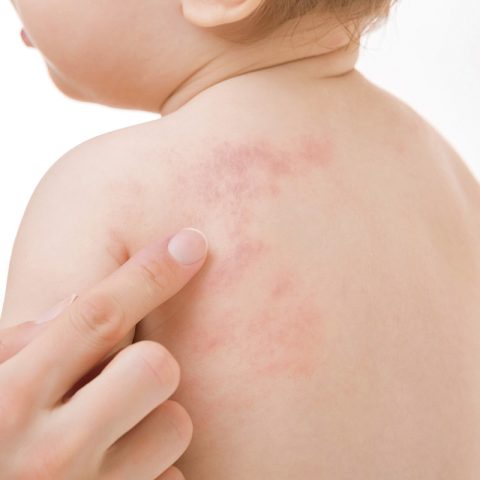 Dermatología pediátrica en Valladolid